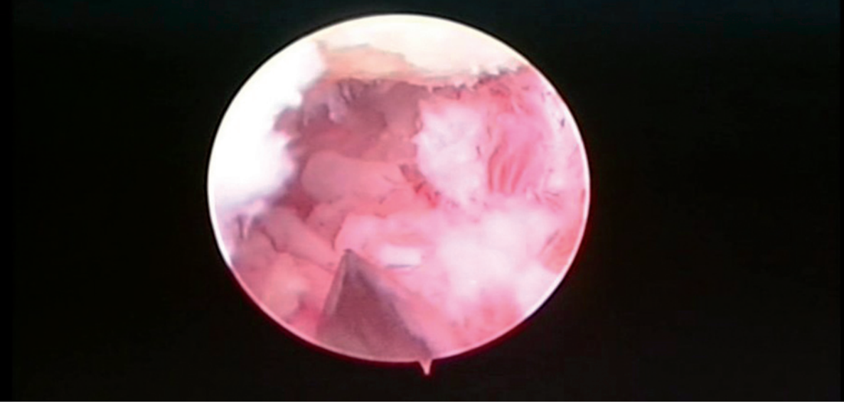 Sinovitis Vellonodular Pigmentada - Blasmaxilo | Dentista en Granada