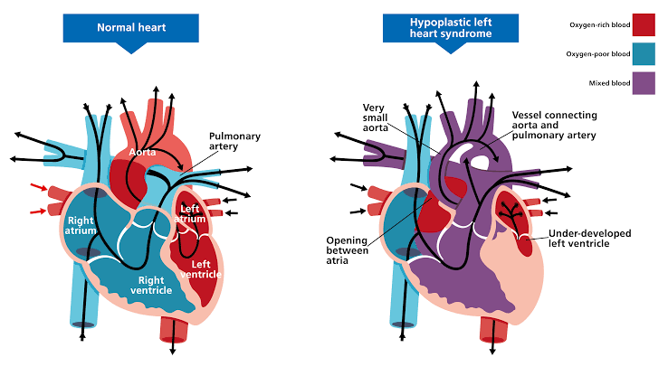 MANAGING PROGERIA: AN IN-DEPTH LOOK AT PATHOPHYSIOLOGY, EARLY DIAGNOSIS ...