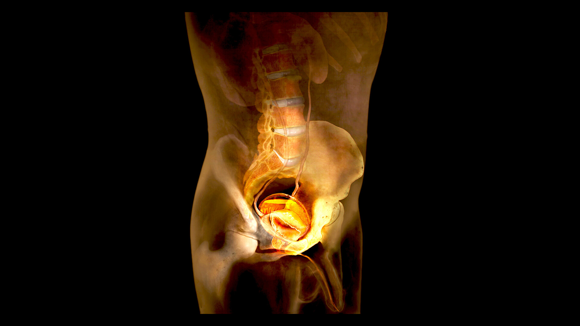 ARGININE VASOPRESSIN RESISTANCE EXPLAINED: A COMPLETE CLINICAL OVERVIEW ...