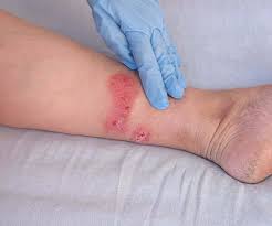 NECROTIZING SOFT-TISSUE INFECTION: A COMPLETE OVERVIEW OF ETIOLOGY ...