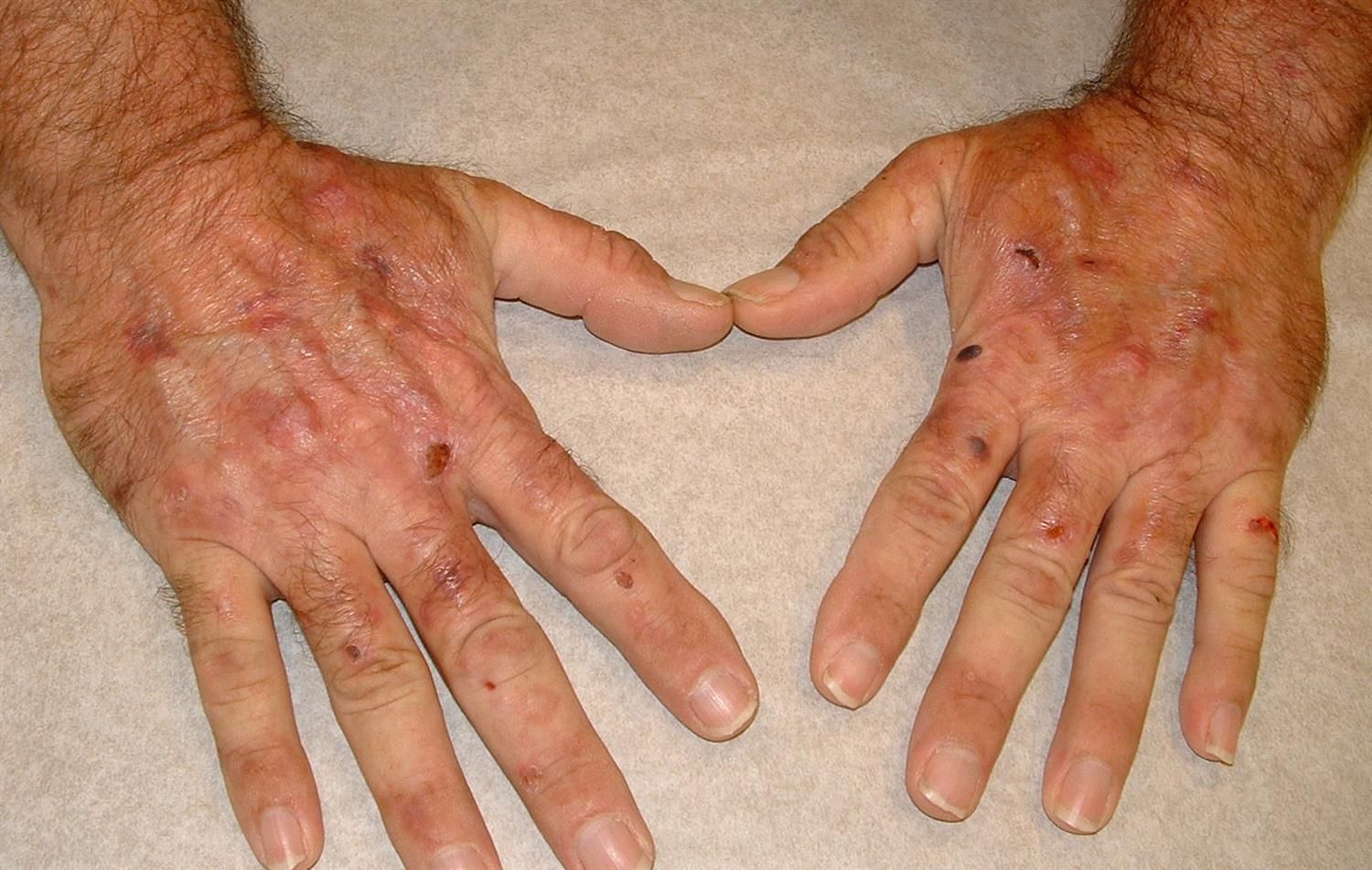 PORPHYRIA CUTANEA TARDA: KEY INSIGHTS AND CLINICAL MANAGEMENT ...