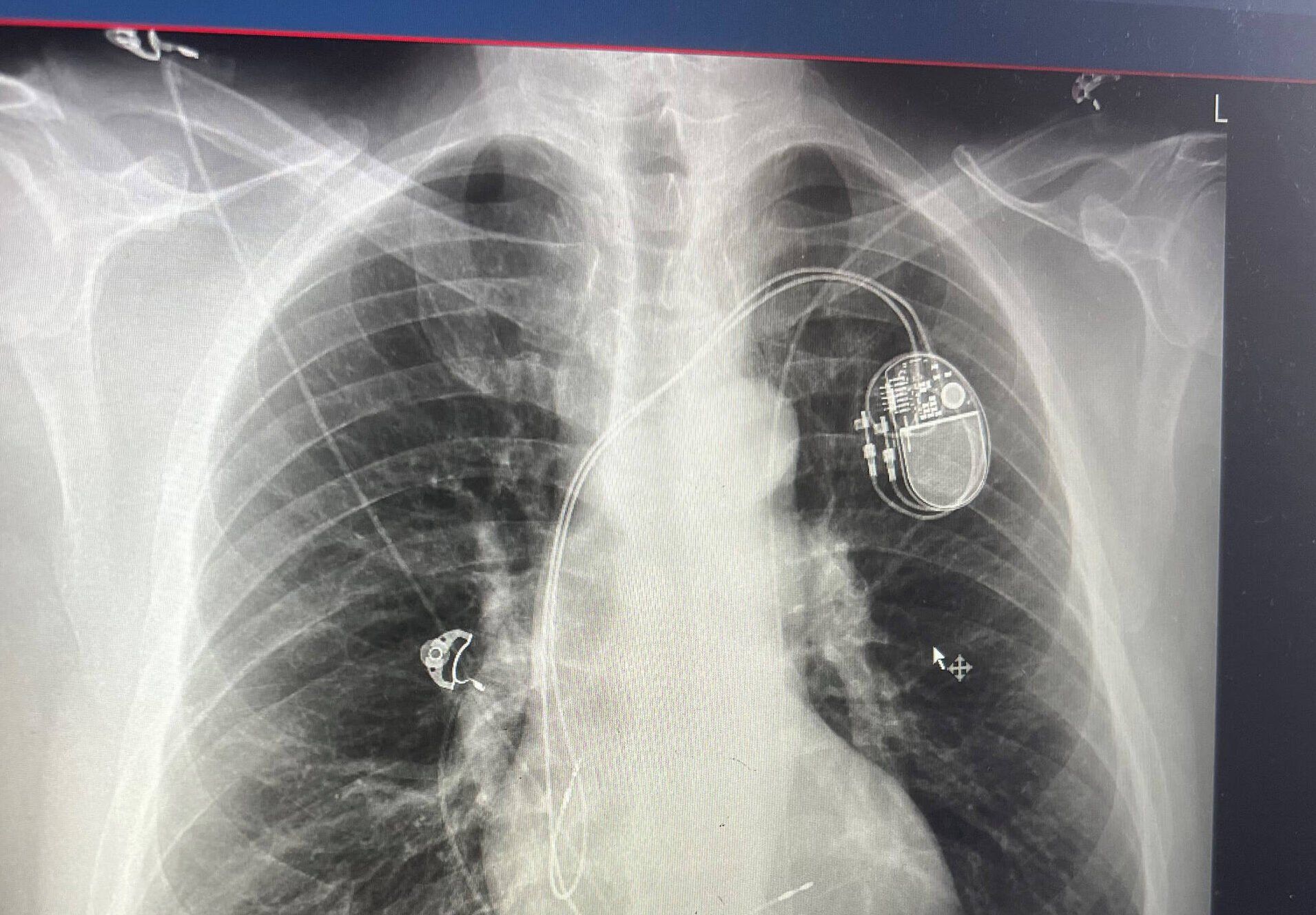 Jesus took three days — I took one and a pacemaker - International News ...