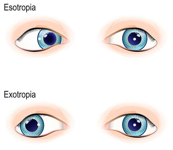 COMPREHENSIVE OVERVIEW OF EXOTROPIA: CLINICAL FEATURES AND ...