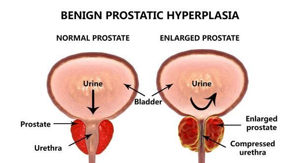 BENIGN PROSTATIC HYPERTROPHY: EFFECTIVE TREATMENT OPTIONS AND REMEDIES ...