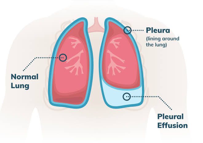 THE SCIENCE BEHIND PLEURAL EFFUSION | MY SCHOOL EXAMS