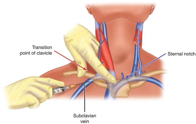 subclavicular notch
