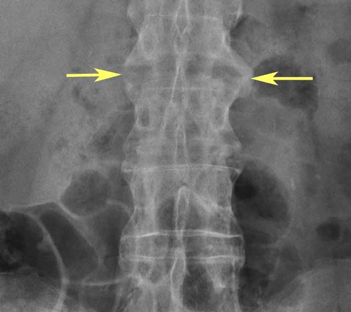 CLINICAL INSIGHTS INTO SERONEGATIVE SPONDYLOARTHROPATHIES ...