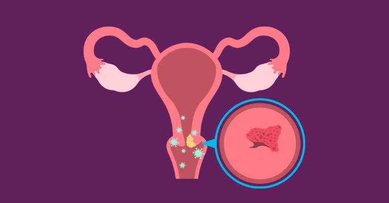 UNDERSTANDING ABNORMAL CERVICAL MUCUS: DIAGNOSIS AND EVIDENCE-BASED ...
